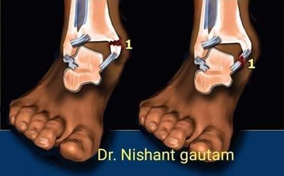 Pijat Urut Kelapa Gading: Kesleo Engkel Kaki