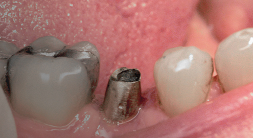 Harris Park Dental Lab in Australia: Cement retained implant crown in ...