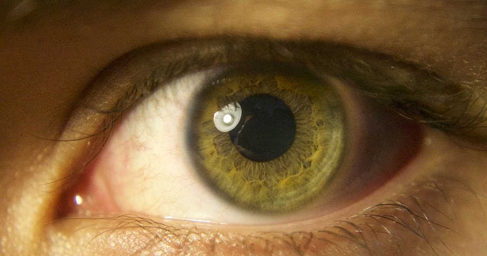 What is Visual impairment: Retina disease, blindness, AMD, DME ...