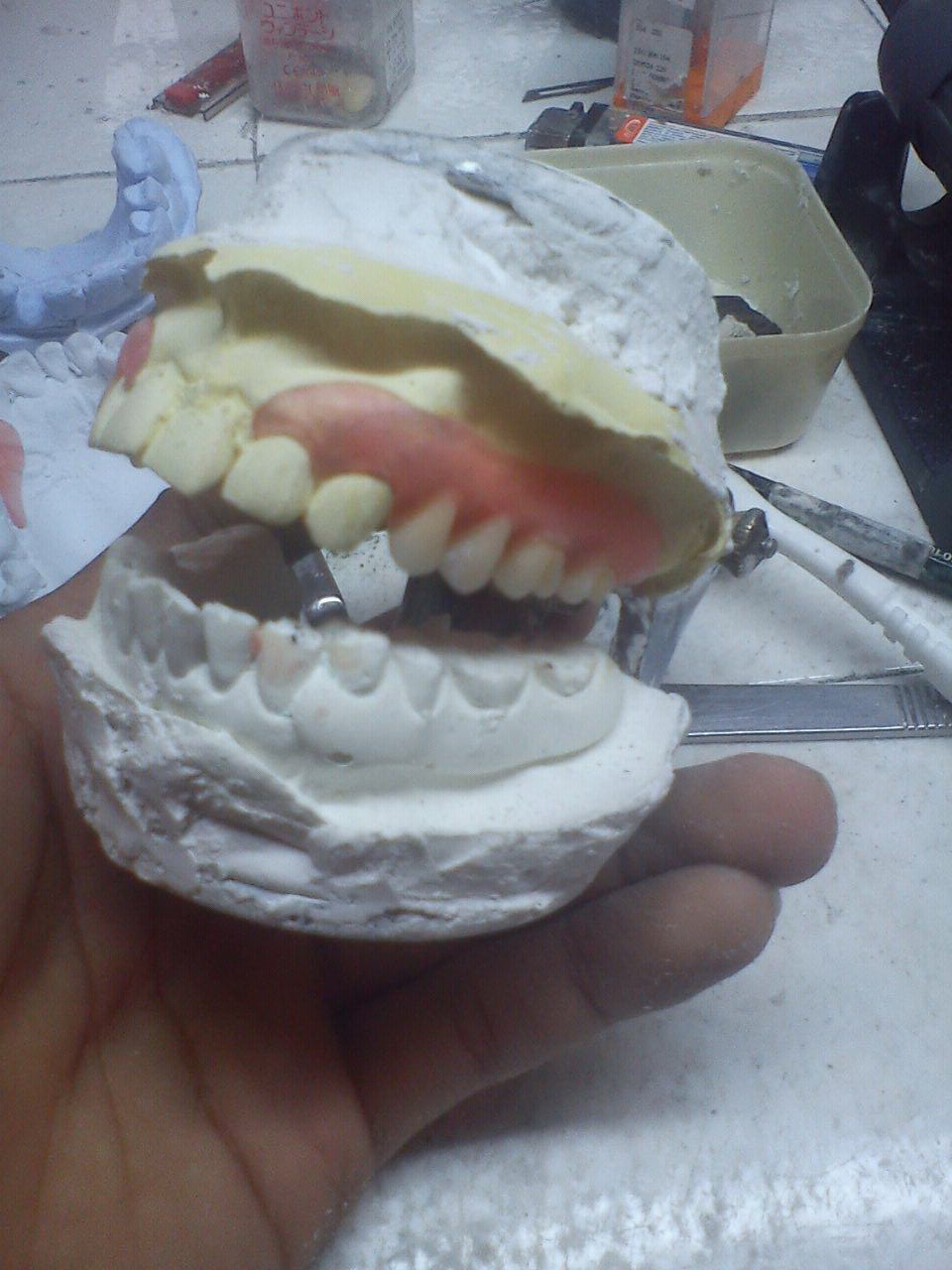 Gigi palsu/ tiruan lepasan Flexyble Valplast ~ Ahli nya Gigi Palsu di ...