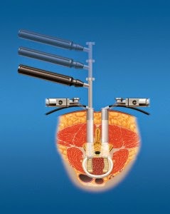 Spine Surgery and Treatment in India : The PLIF and TLIF approach has ...