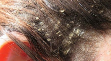 Dandruff, Causes And Symptoms And How To Overcome It - Adimasrosid Blog