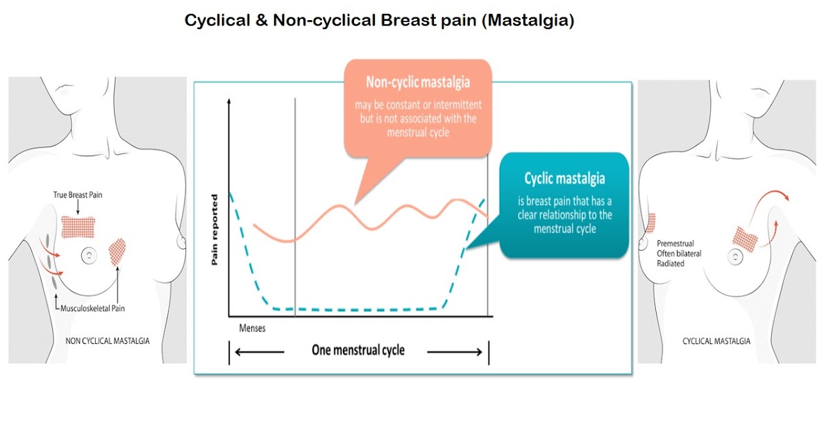 The Family physician : Breast pain (Mastalgia)