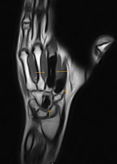 Melorheostosis - Sumer's Radiology Blog