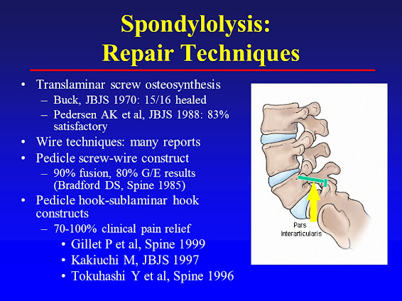 Spondylolysis/Pars Fracture: Surgical Treatment Part 6 | Growing Spine ...
