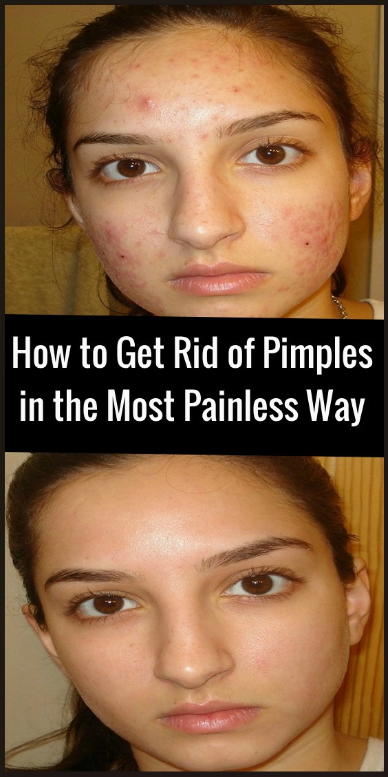How to Get Rid of Pimples in the Most Painless Way