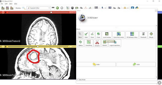 Everything Modelling and Simulation: Medical Image Segmentation with 3D ...
