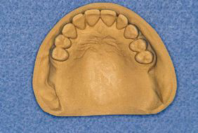 RPD 부분틀니 디자인 kennedy class 1 후방연장 국소의치 ~ Healthy Happy