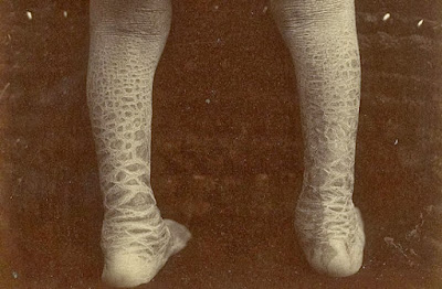 Ichthyosis Treatment: What Is Ichthyosis? - Health Article