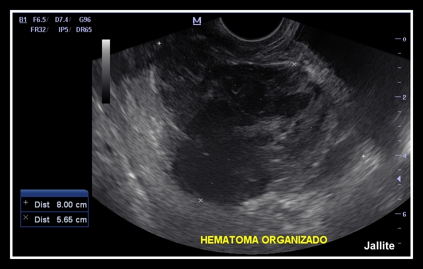 Hematoma Post-Cesarea