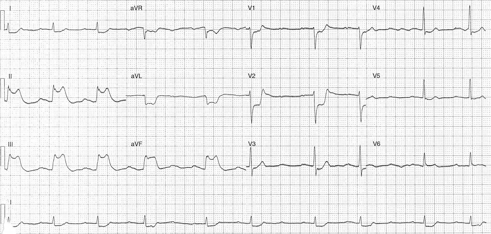 ECG of the Week: ECG of the Week - 27th November 2017