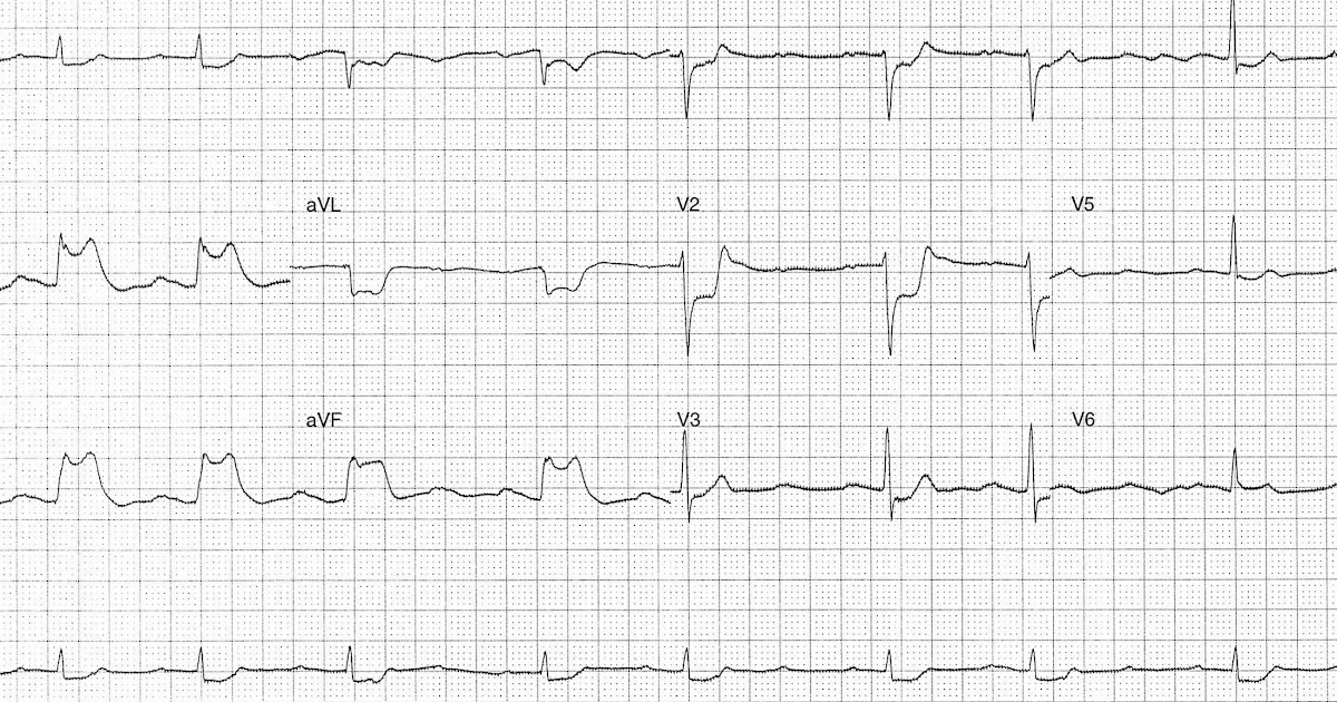 ECG of the Week: ECG of the Week - 27th November 2017