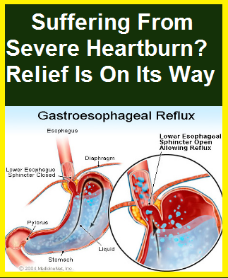 Natural Heartburn Relief: Severe Heartburn Relief