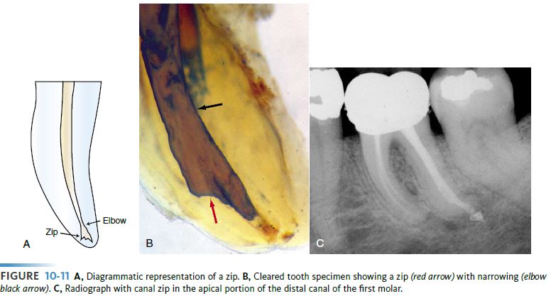 What is Ledge, Zipping, Strip Perforation and Apical Transportation in ...