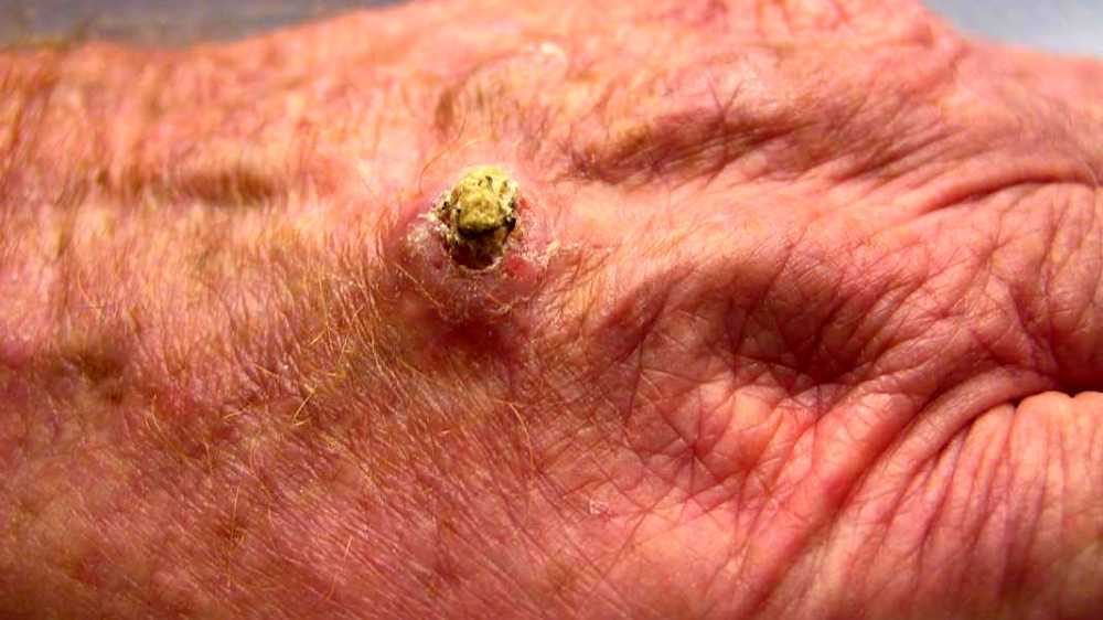 Squamous Cell Carcinoma