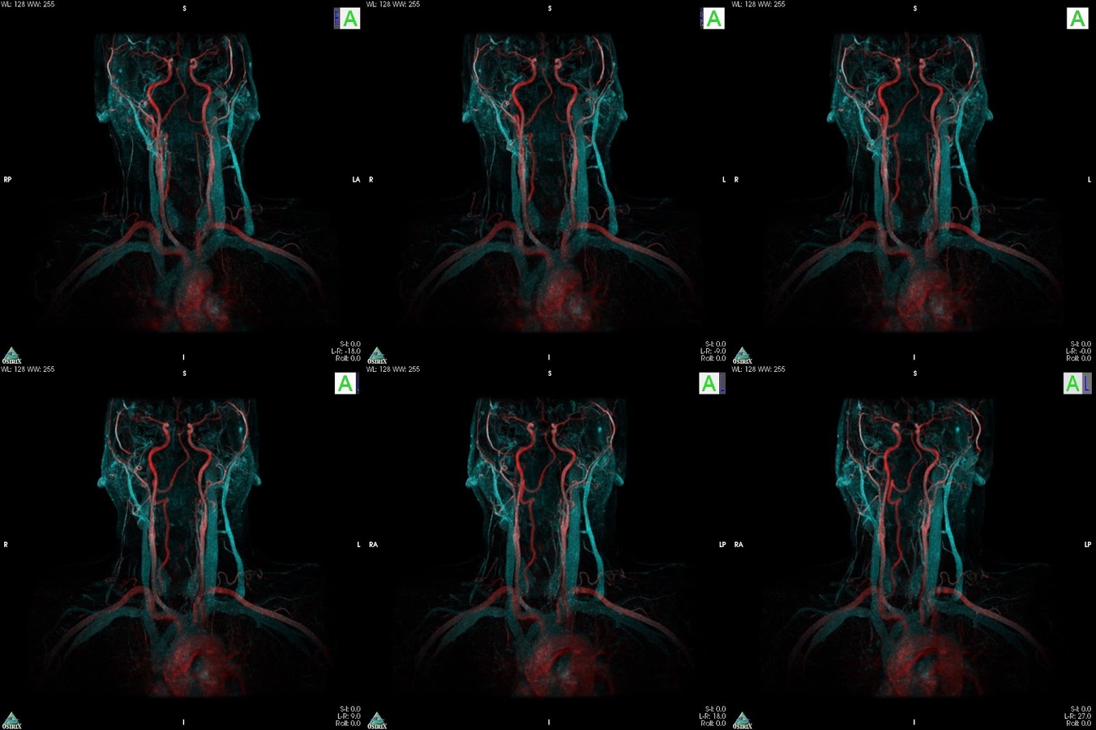 Nevit's blog: How to Create Color MR Angiography using Osirix and Color ...