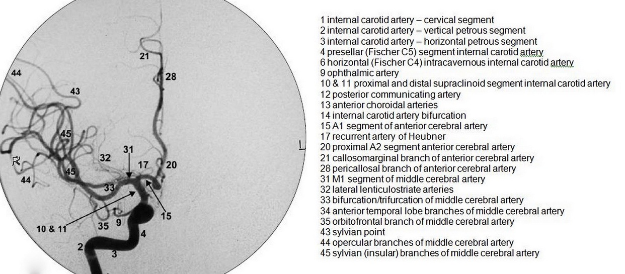 Dr Balaji Anvekar FRCR: Recurrent artery of Heubner Infarct