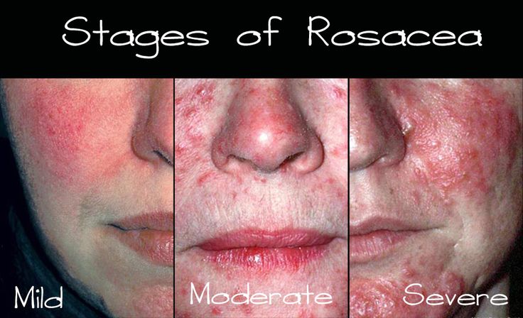 Study Medical Photos: A Brief Description Of Acne Rosacea