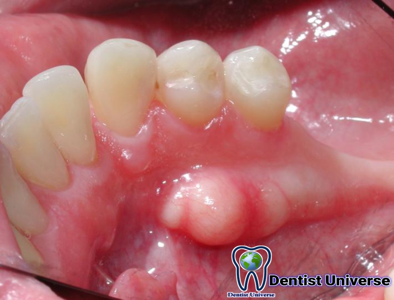 Normal oral cavity variations