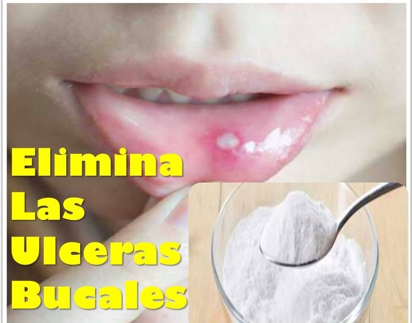 Alivia Las Ulceras Bucales (Aftas) Con estos Tratamientos naturales