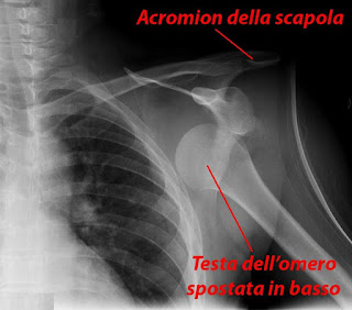 Fisioterapia per tutti: Lussazione di spalla