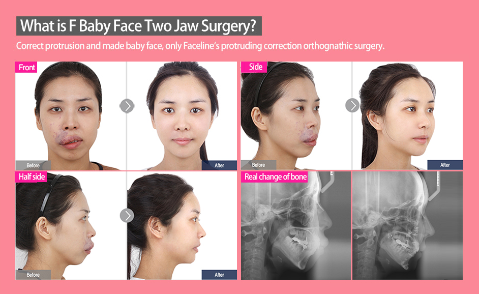 Protruding Mouth Correction F Baby Face Two Jaw Surgery