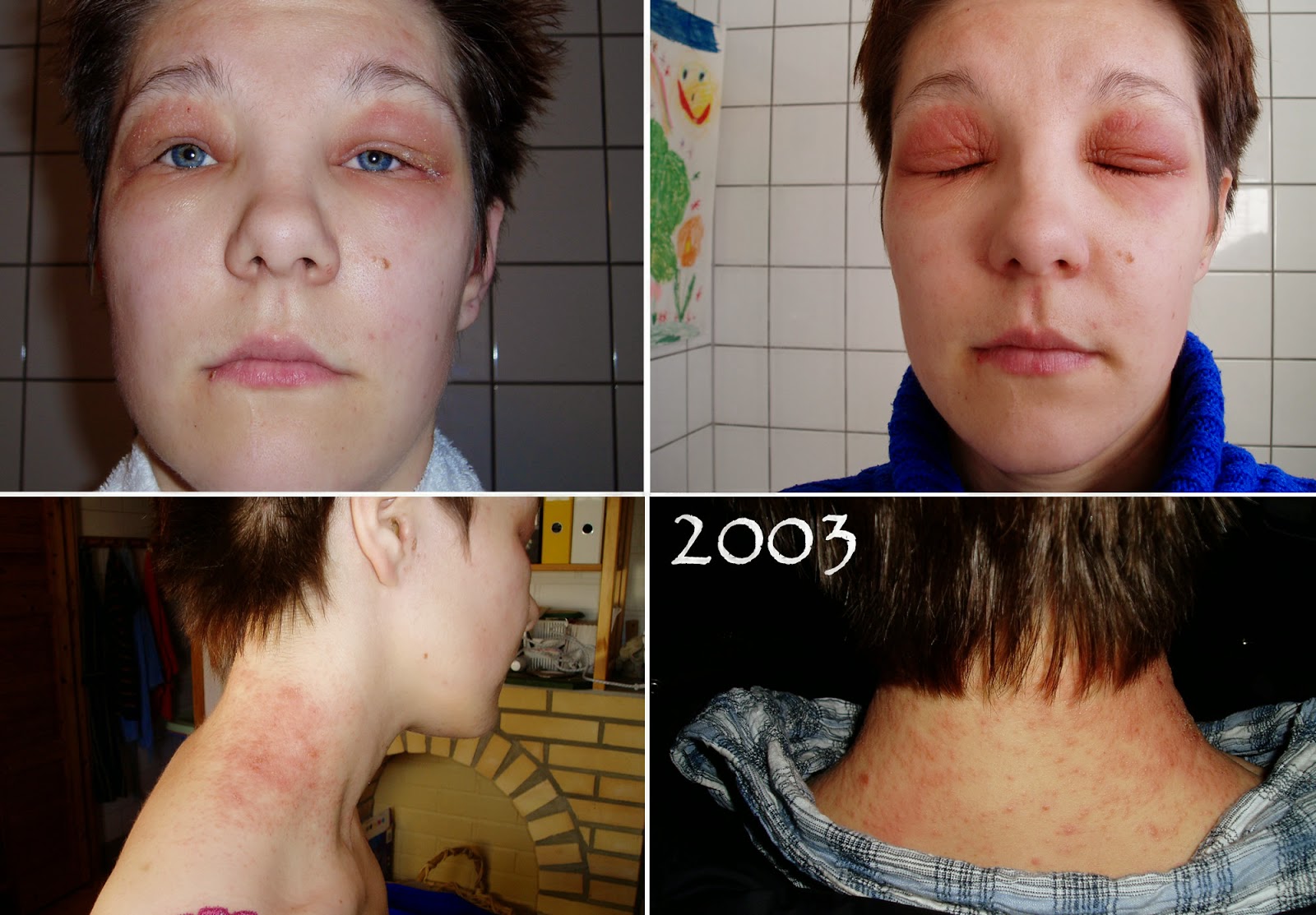 Ingeborg's Lotta: Eksem och diskbråck C6-C7