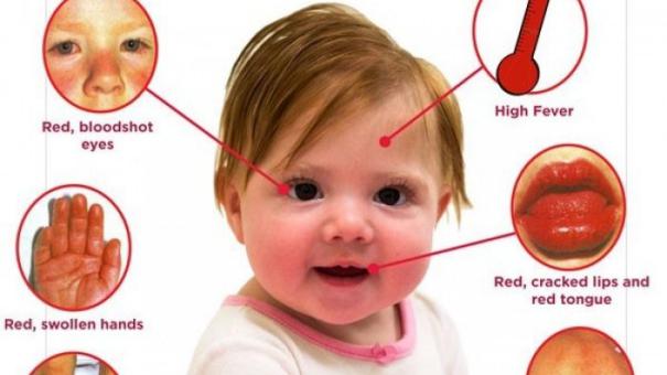 Cara Menyembuhkan Demam Scarlet Secara Alami Sampai Tuntas 100% Efektif ...