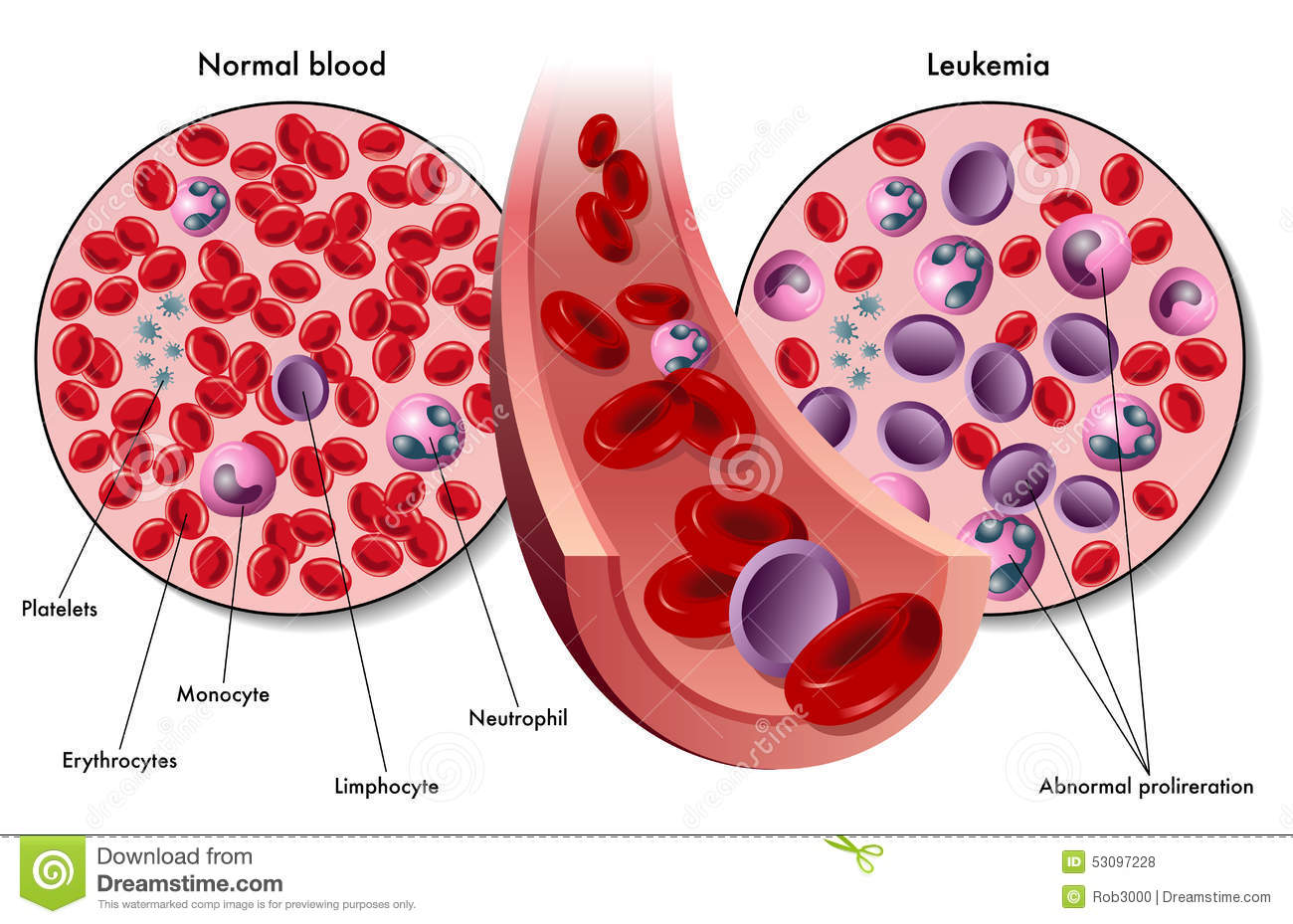 Acute myeloid leukemia (AML) ~ Health Care Tips
