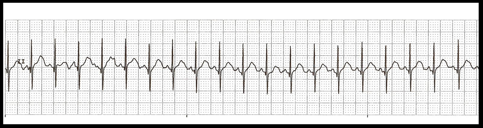 ACLS review: Pulseless Electrical Activity- part 1