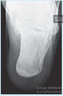 Creación de protocolos. MMSS, MMII, Cadera y Pelvis: Calcáneo