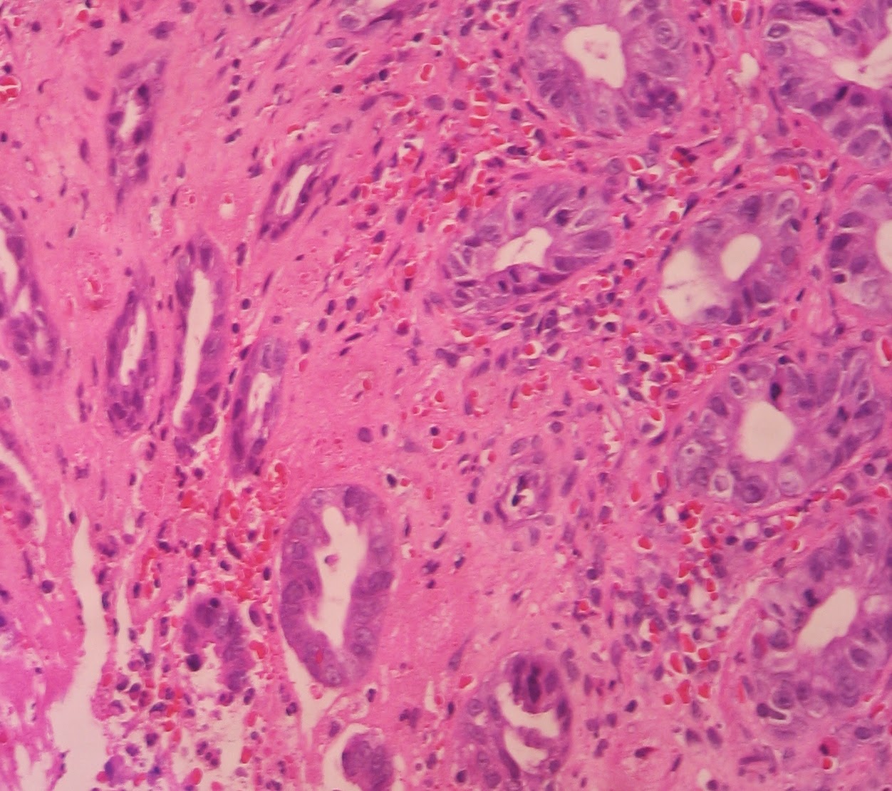 GASTROINTESTINAL AND LIVER HISTOLOGY PATHOLOGY ATLAS: COLON: ISCHEMIC ...