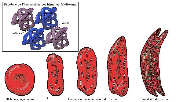 #DrépaConseils: La drépanocytose : La Maladie