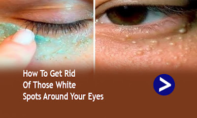 How To Get Rid Of Those White Spots Around Your Eyes - Draco Beauty