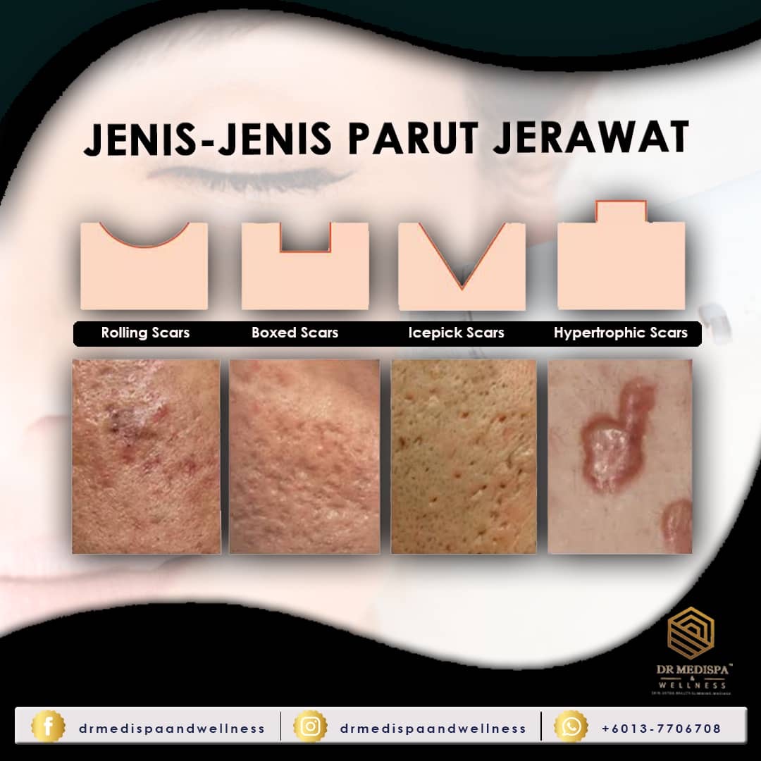 JOM BUAT RAWATAN MENGHILANGKAN PARUT DAN JERAWAT DI DR MEDISPA AND ...