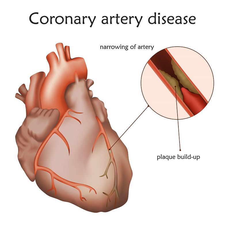Organicdietguide Cholesterol Blocked Arteries Causes And Treatments organicdietguide-cholesterol-blocked-arteries-causes-and-treatments
