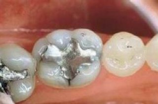 Actualidad Dental: La amalgama dental no contiene ningún riesgo para la ...