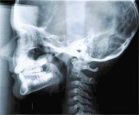 Ehlers-Danlosin syndrooma: Suun ja leukanivelalueen muutokset!