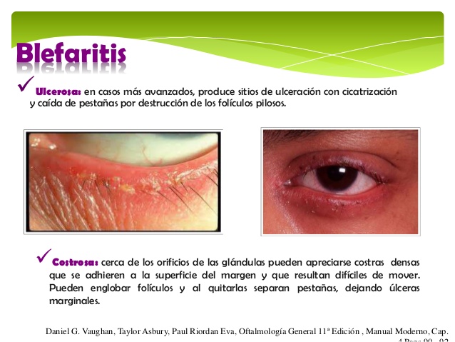 Higiene de los Ojos VS Blefaritis - Por Una Visión Saludable