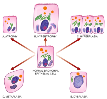 Adaptive Disorder/Changes in Cell | Atrophy, Hypertrophy, Hyperplasia ...