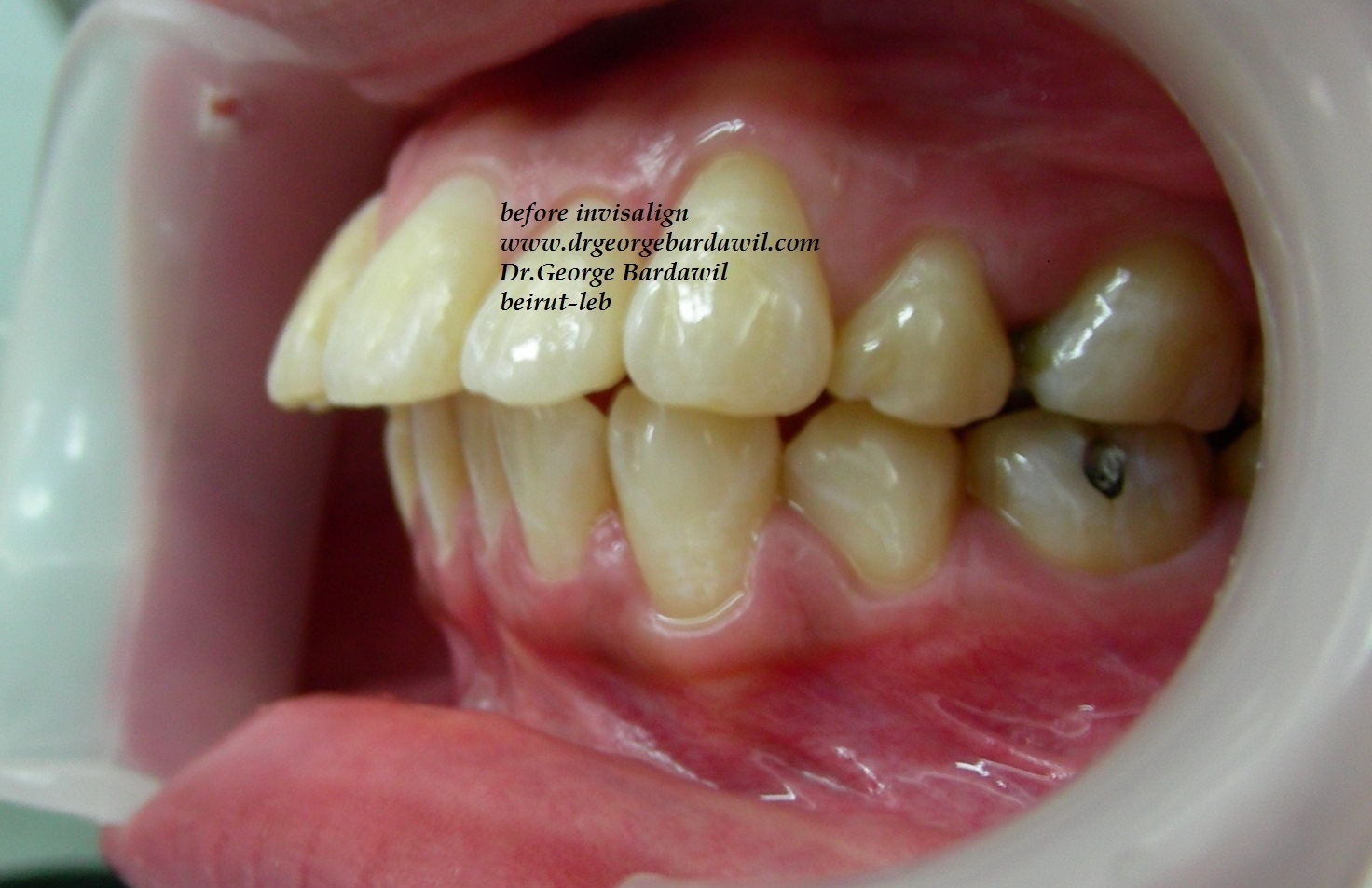 Dr.George E. Bardawil-Orthodontist-Invisalign Diamond level : FINISHED ...