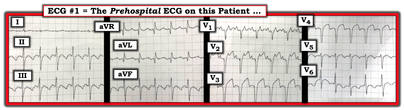 Dr. Smith's ECG Blog: December 2019