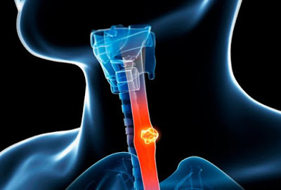 Wawasan tentang Kanker Esofagus Stadium 4 - Jago Lamaran