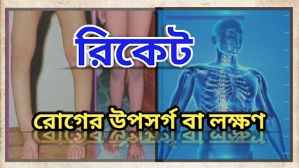 রিকেট-Rickets: উপসর্গ, কারণ, চিকিৎসা, ঔষধ, প্রতিরোধ, রোগ নির্ণয় কি ...