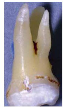 dentistry : FURCATION INVOLVEMENT