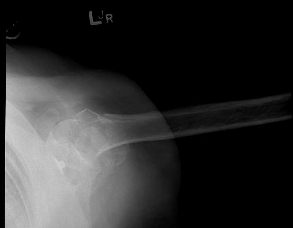 Shoulder and Elbow Surgery: Proximal humerus fracture dislocation with ...