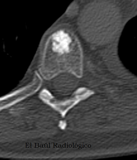 El Baúl Radiológico: ENOSTOSIS: ISLOTE ÓSEO (Bone Island: CT and MRI ...
