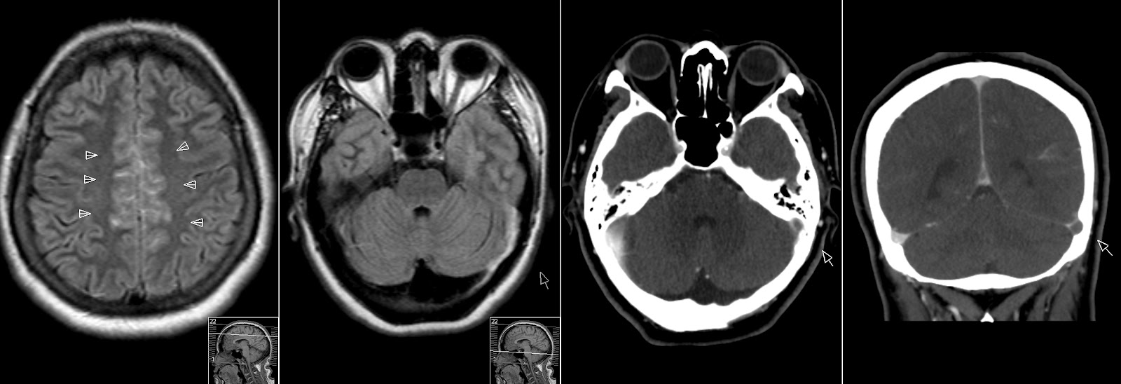 Sinus Thrombosis with SAB