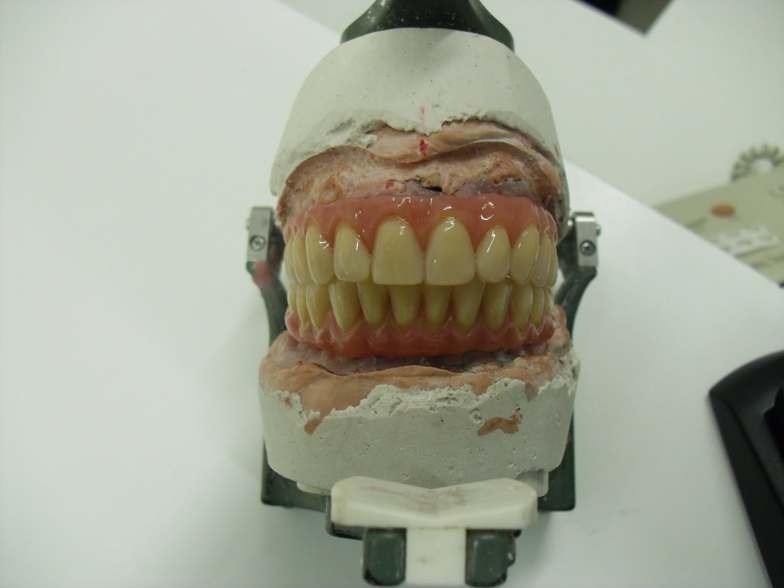 J.M Prótese Dentária: protocolo superior e inferior , carga imediata.