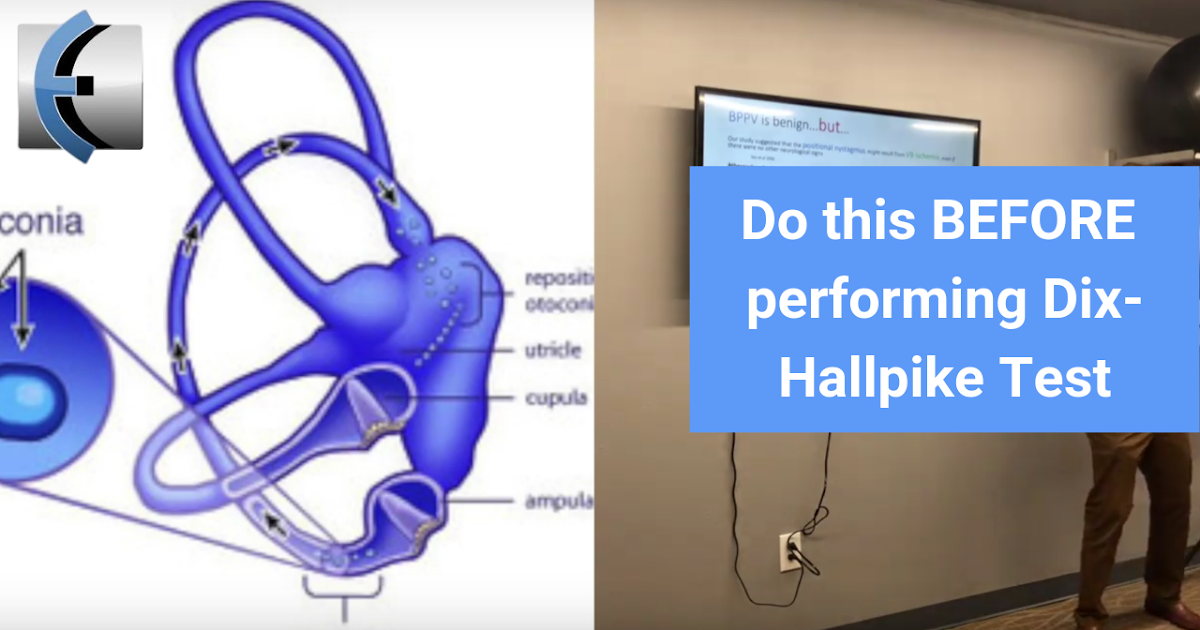 Do THIS before performing Dix-Hallpike Manuever | Modern Manual Therapy ...